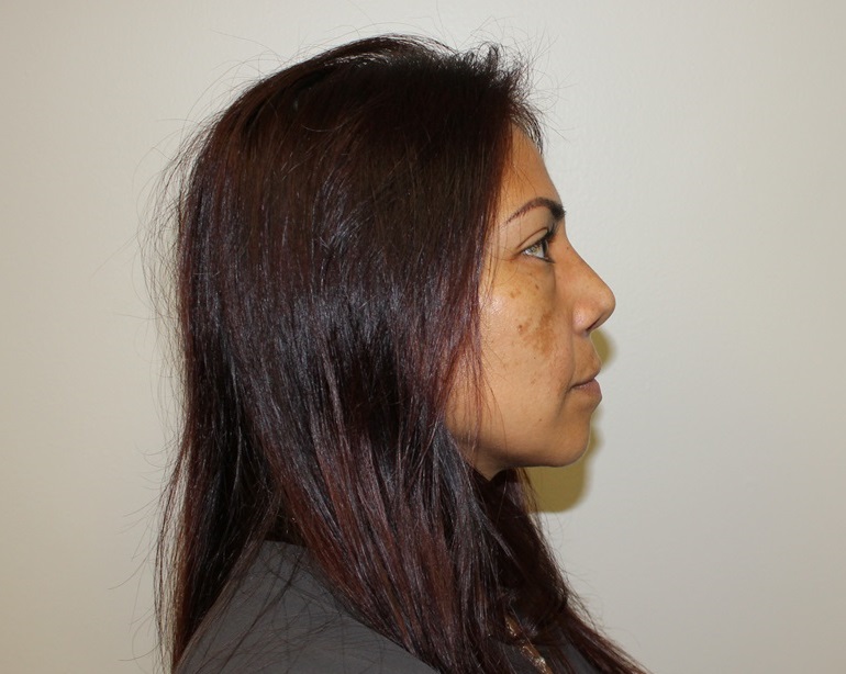 Rhinoplasty Before and After Photos by Kyle Shaddix, MD; Pensacola, FL ...