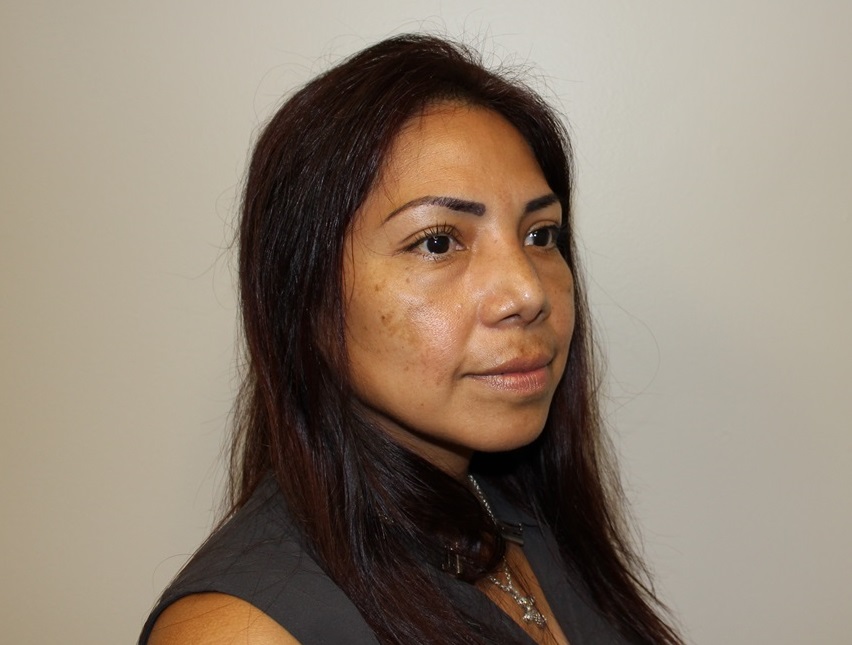 Rhinoplasty Before and After Photos by Kyle Shaddix, MD; Pensacola, FL ...