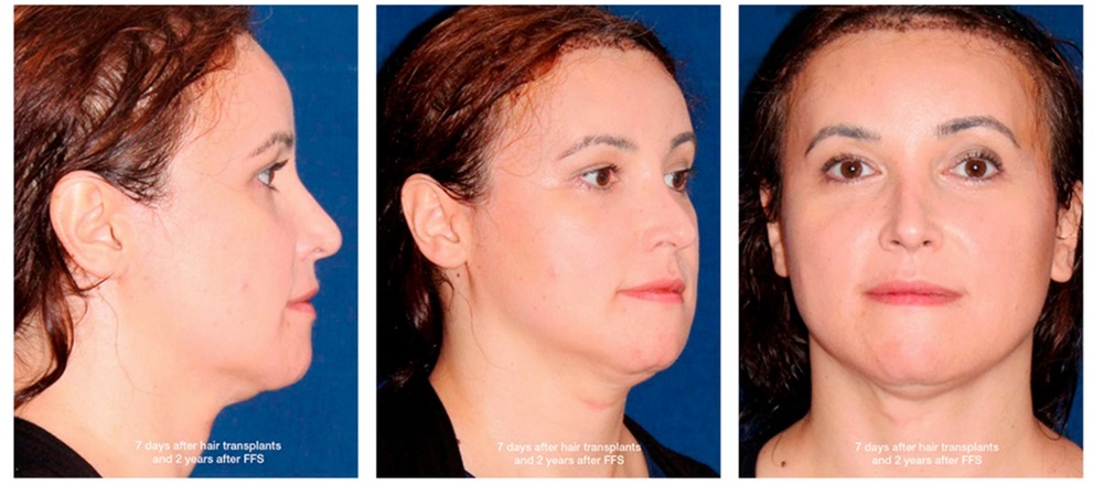 Skull/Facial Bone Reconstruction Before and After Photos by Javier ...