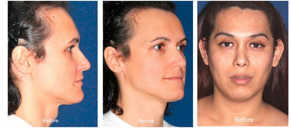 Skull/Facial Bone Reconstruction Before and After Photos by Javier ...