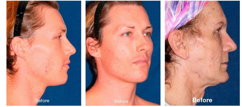 Skull/Facial Bone Reconstruction Before and After Photos by Javier ...