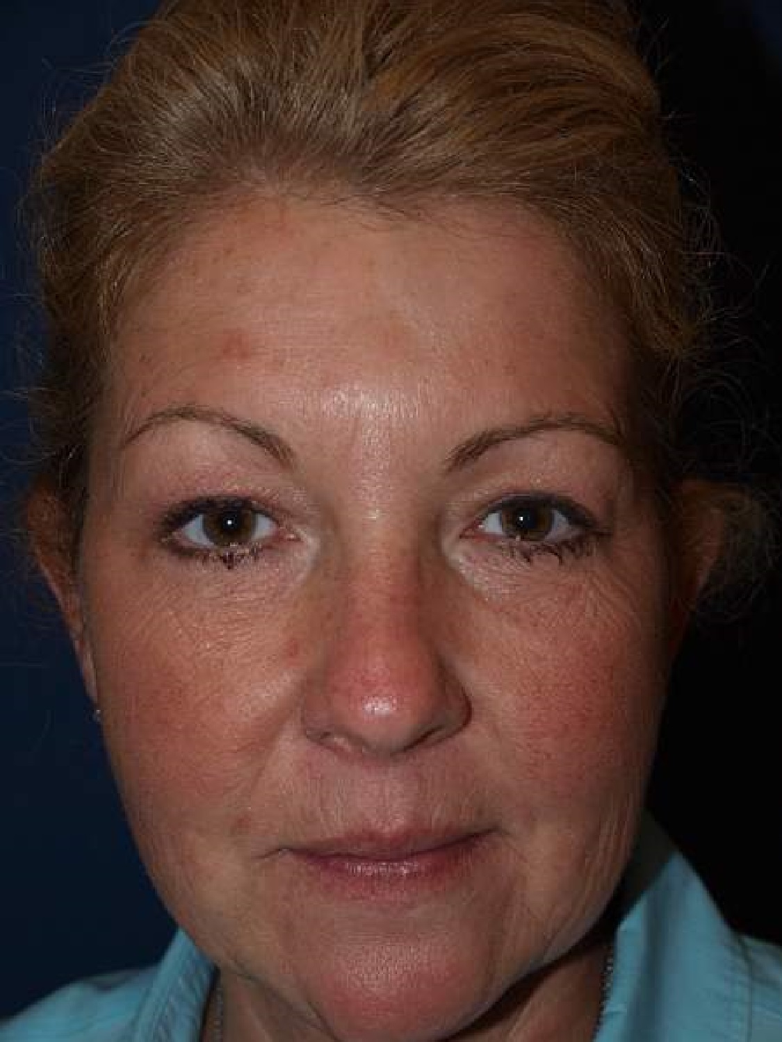 Eyelid Surgery Before and After Photos by Bruce Brewer, MD, FACS ...