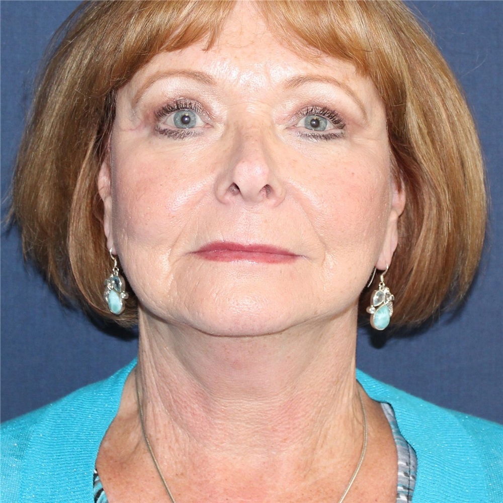 Facelift Before and After Photos by Brian Windle, MD; Aspen, CO - Case ...