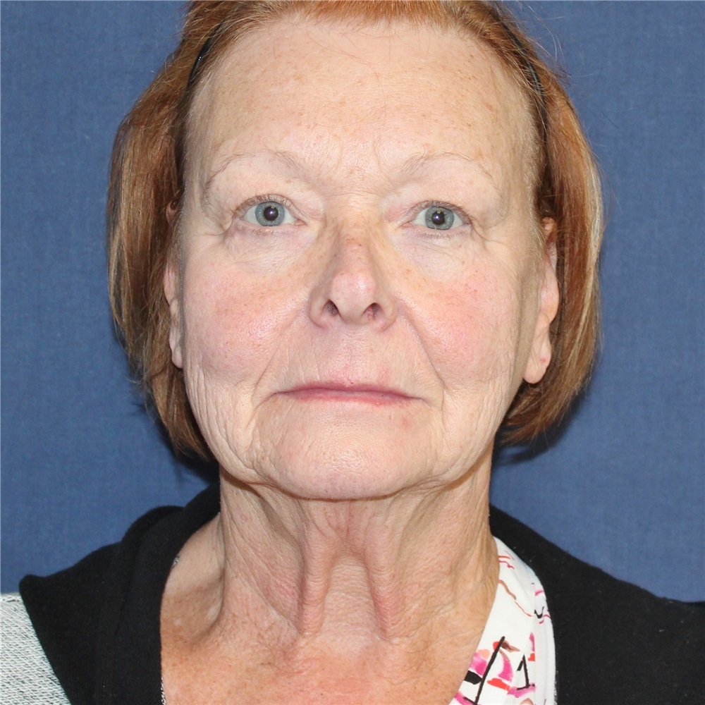 Facelift Before and After Photos by Brian Windle, MD; Aspen, CO - Case ...