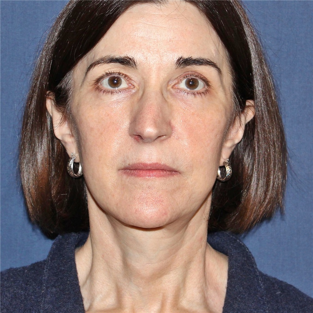 Facelift Before and After Photos by Brian Windle, MD; Aspen, CO - Case ...