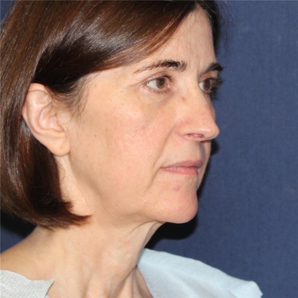 Facelift Before and After Photos by Brian Windle, MD; Aspen, CO - Case ...