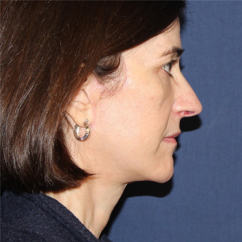 Facelift Before and After Photos by Brian Windle, MD; Aspen, CO - Case ...