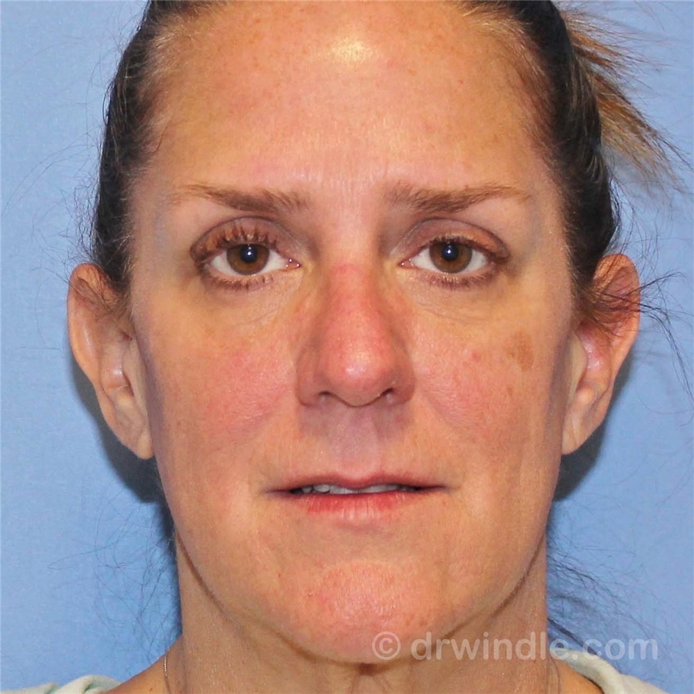 Dermal Fillers Before and After Photos by Brian Windle, MD; Aspen, CO ...