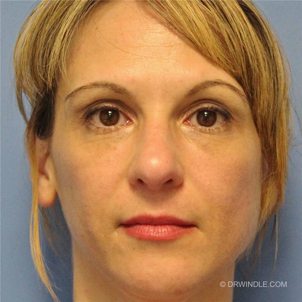 Dermal Fillers Before and After Photos by Brian Windle, MD; Aspen, CO ...