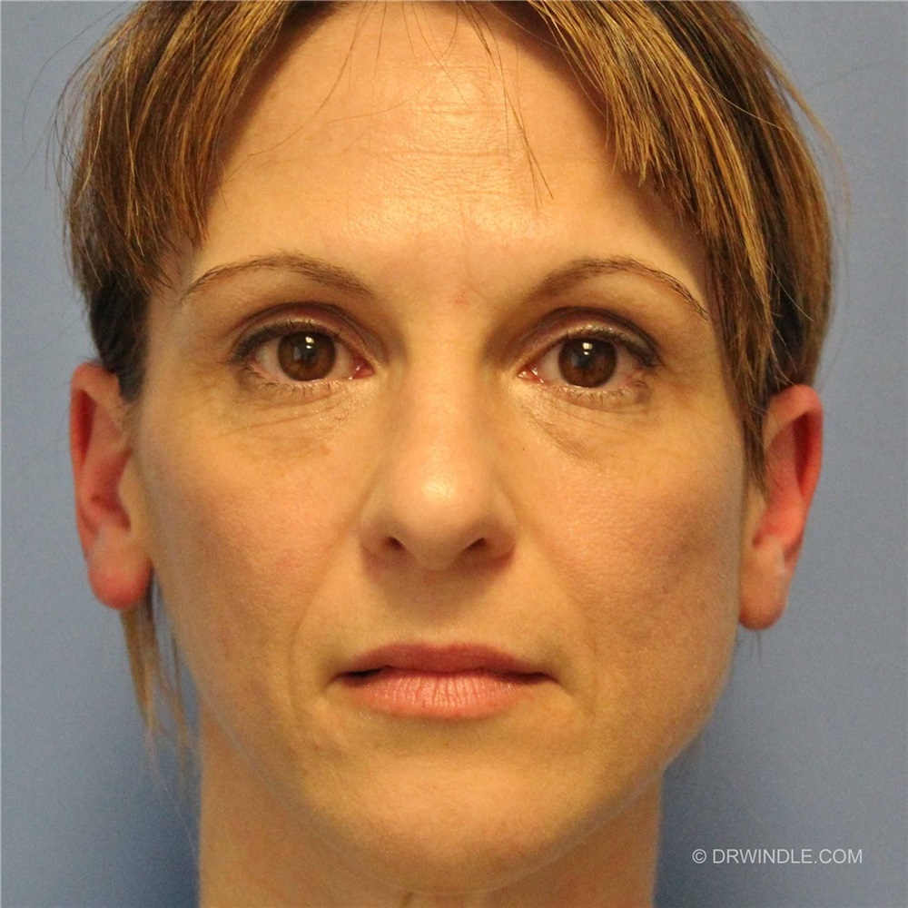 Dermal Fillers Before and After Photos by Brian Windle, MD; Aspen, CO ...