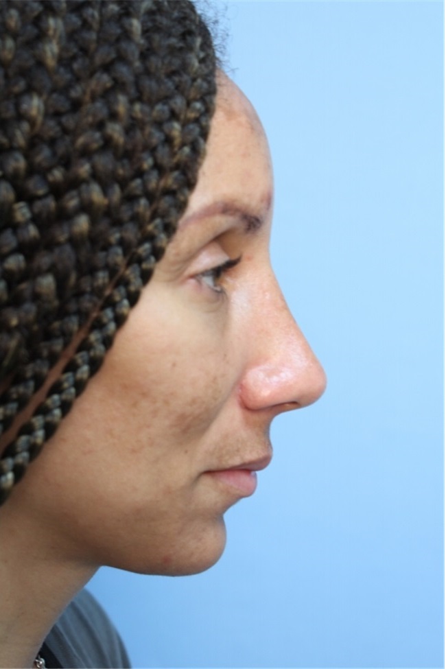 Rhinoplasty Before and After Photos by Richard Clark, MD; Sacramento ...