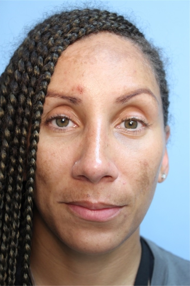 Rhinoplasty Before and After Photos by Richard Clark, MD; Sacramento ...