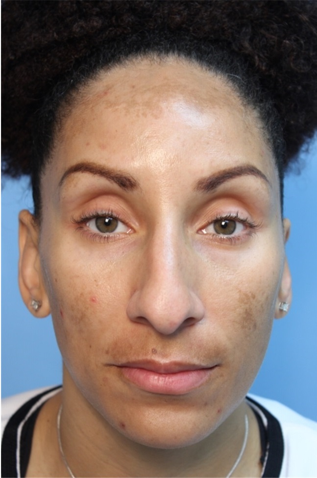 Rhinoplasty Before and After Photos by Richard Clark, MD; Sacramento ...