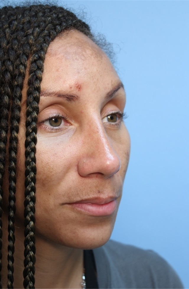 Rhinoplasty Before and After Photos by Richard Clark, MD; Sacramento ...