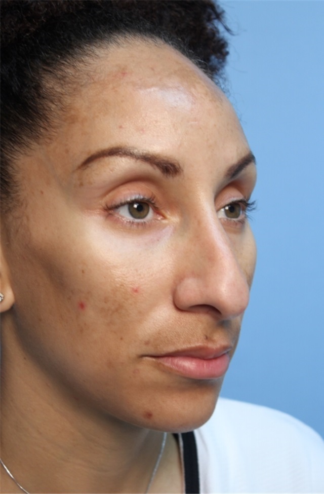 Rhinoplasty Before and After Photos by Richard Clark, MD; Sacramento ...