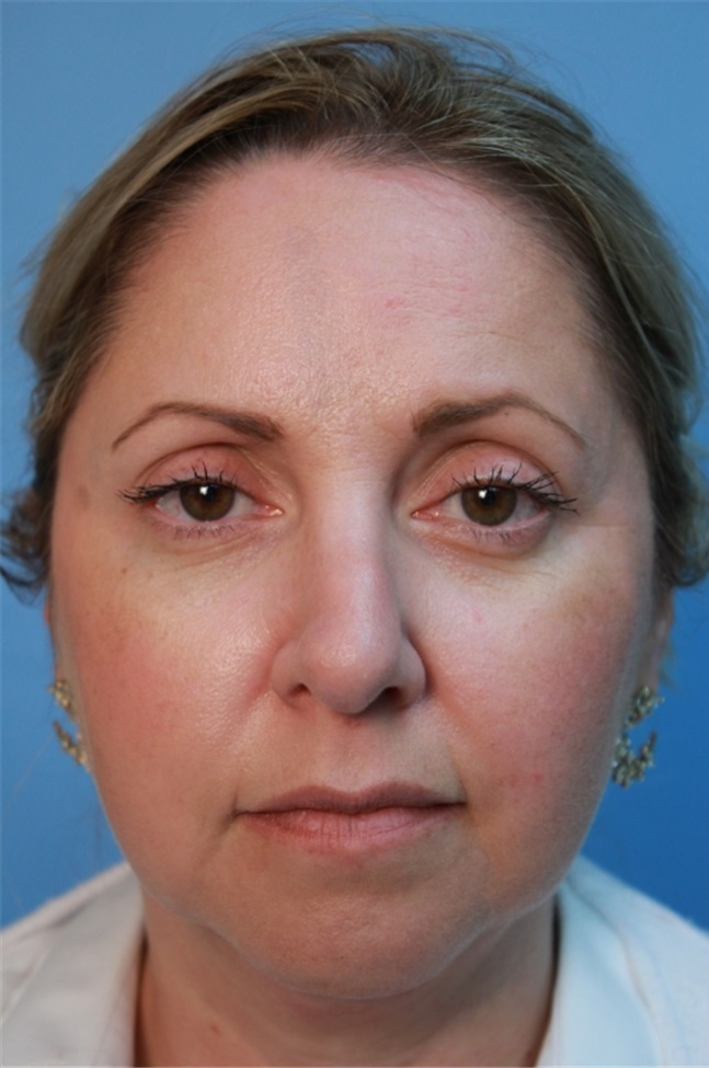 Rhinoplasty Before and After Photos by Richard Clark, MD; Carmichael ...