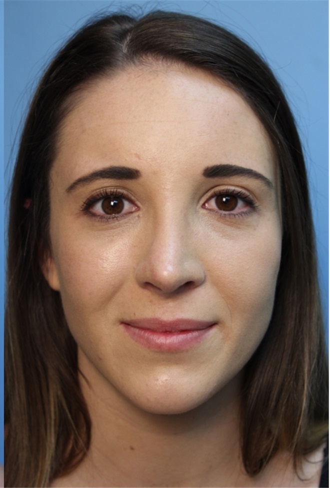 Rhinoplasty Before and After Photos by Richard Clark, MD; Carmichael ...