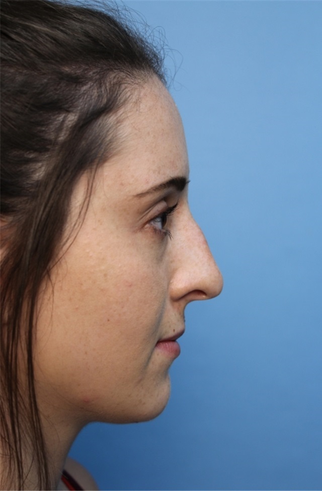 Rhinoplasty Before and After Photos by Richard Clark, MD; Carmichael ...