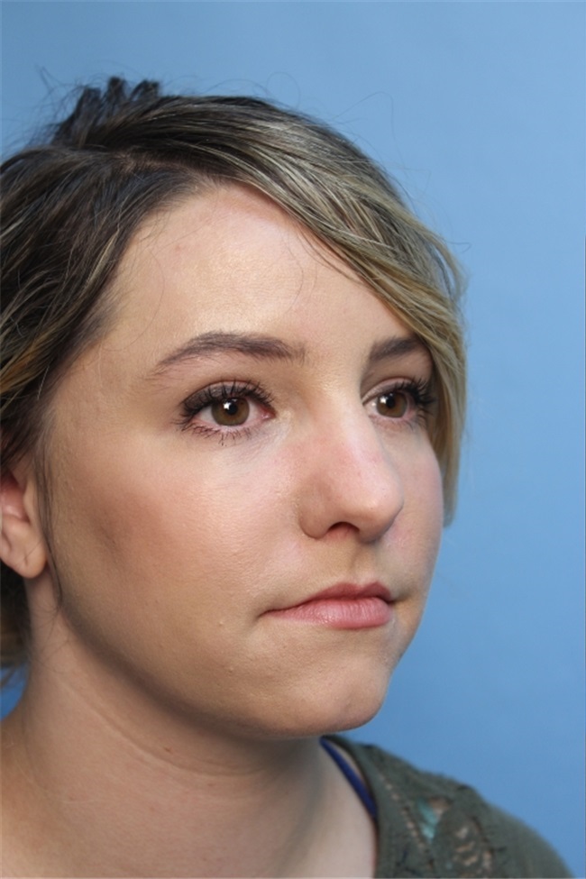 Rhinoplasty Before and After Photos by Richard Clark, MD; Carmichael ...
