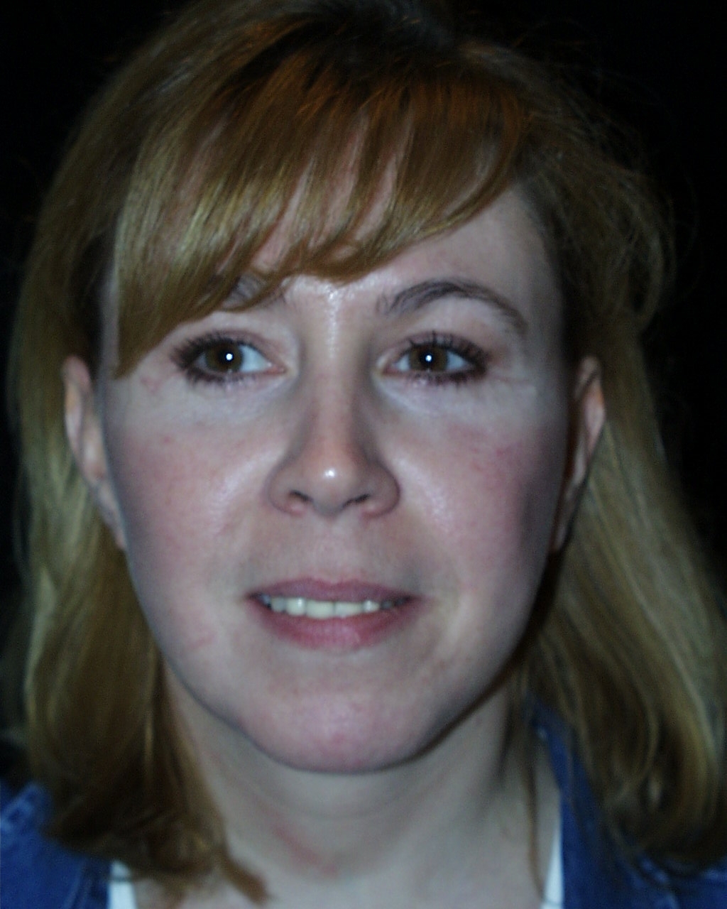 Facelift Before and After Photos by David Lange, MD; Mendham, NJ - Case ...