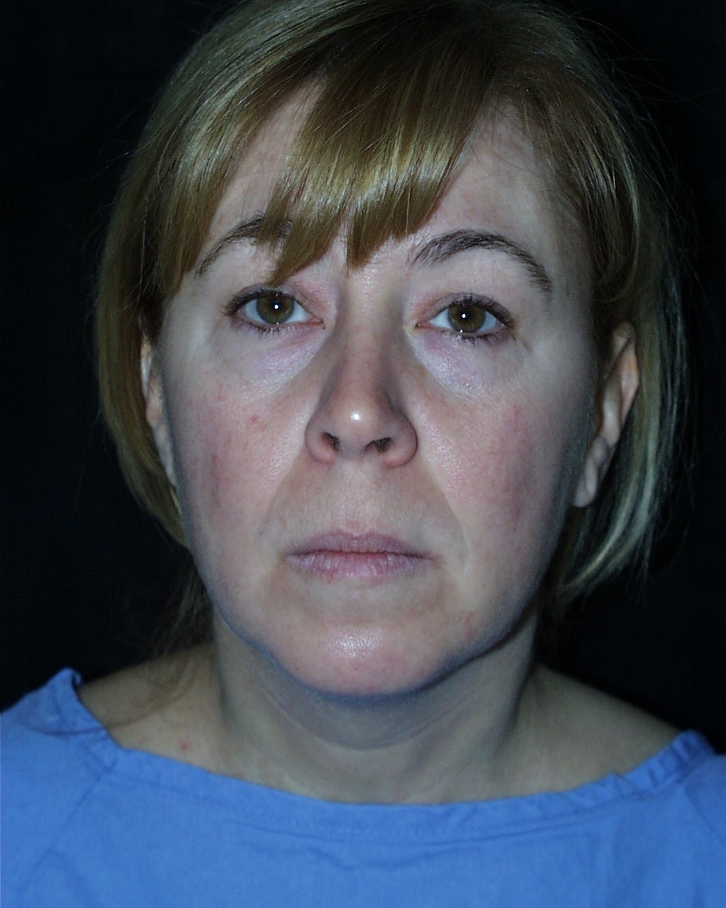 Facelift Before and After Photos by David Lange, MD; Mendham, NJ - Case ...