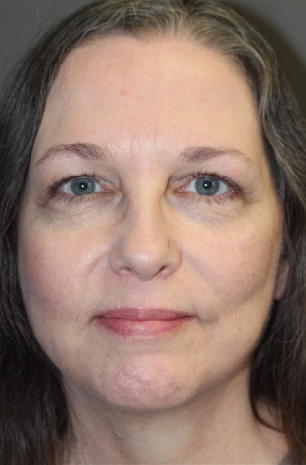 Facelift Before and After Photos by Leonard Miller, MD; Brookline, MA ...