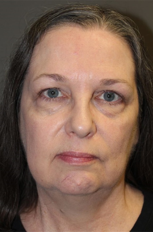 Facelift Before and After Photos by Leonard Miller, MD; Brookline, MA ...