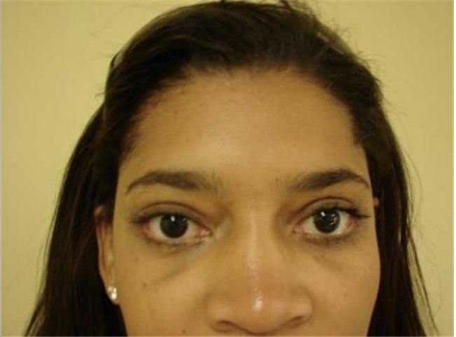 Eyelid Surgery Before and After Photos by Kimberly Henry, MD; , - Case ...