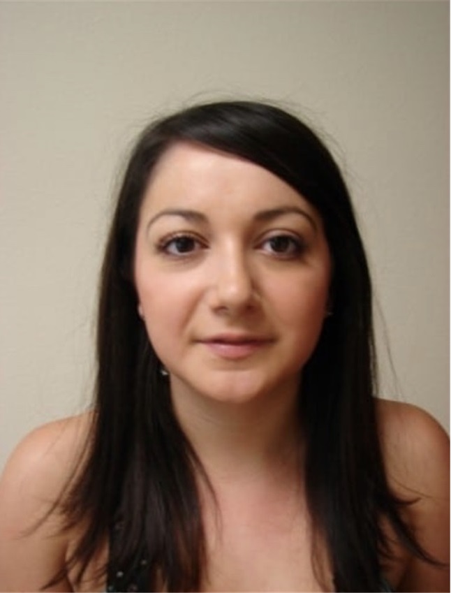 Rhinoplasty Before and After Photos by Kimberly Henry, MD; Greenbrae ...