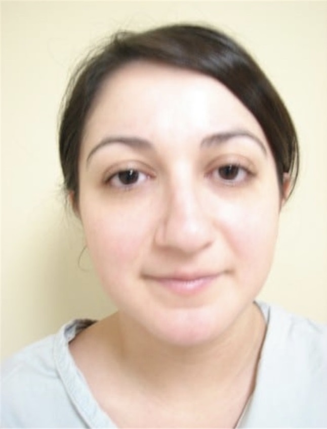 Rhinoplasty Before and After Photos by Kimberly Henry, MD; Greenbrae ...