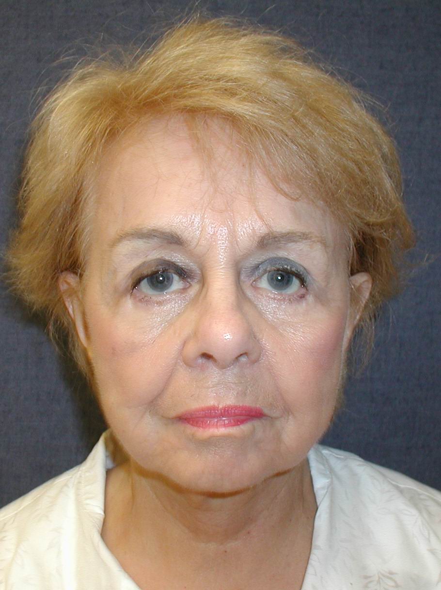 Facelift Before and After Photos by Guy Stofman, MD; Pittsburgh, PA ...