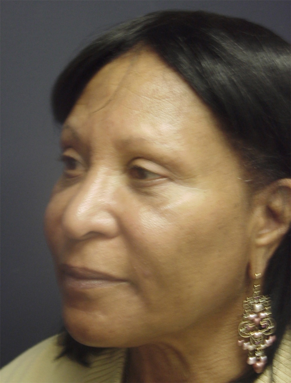 Facelift Before and After Photos by Emily Pollard, MD; Ardmore, PA ...