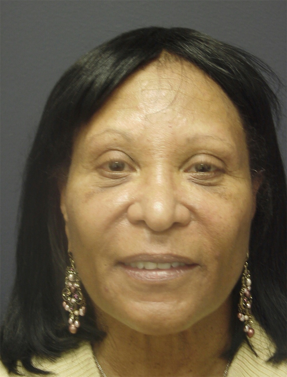 Facelift Before and After Photos by Emily Pollard, MD; Ardmore, PA ...