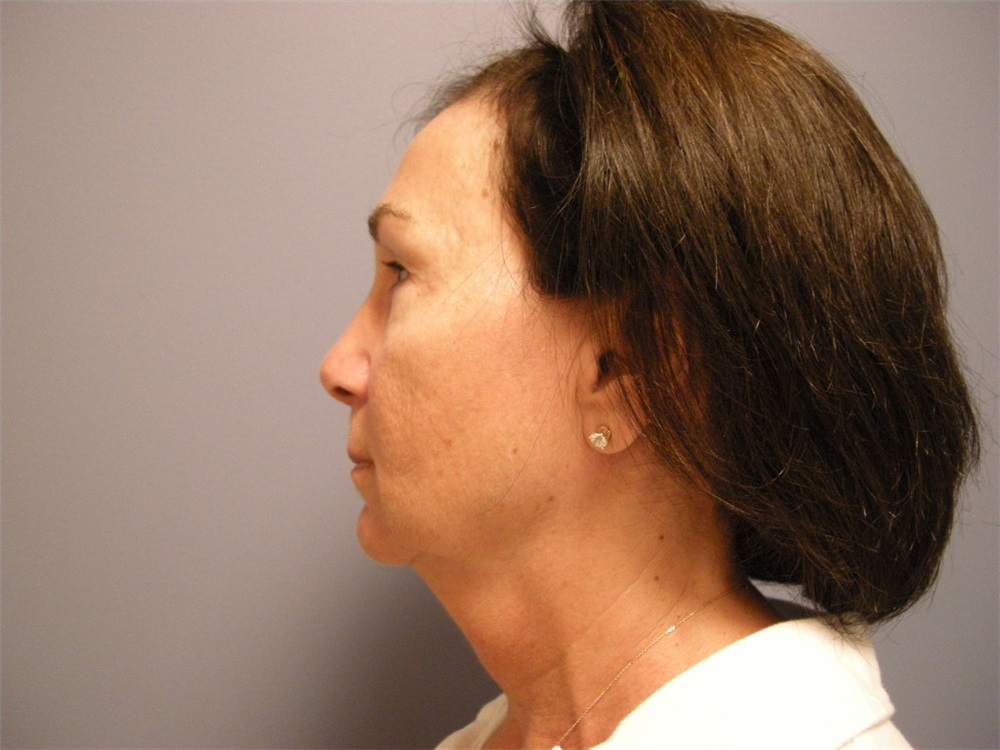 Facelift Before and After Photos by Emily Pollard, MD; , - Case 25517 ...