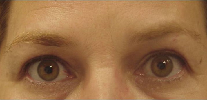 Eyelid Surgery Before and After Photos by Emily Pollard, MD; Bala ...