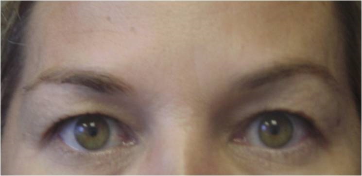 Eyelid Surgery Before and After Photos by Emily Pollard, MD; Bala ...