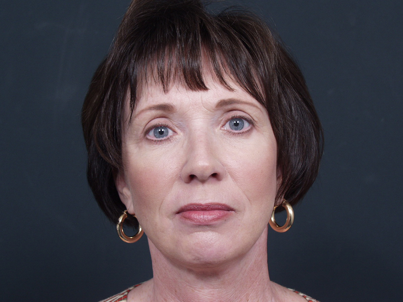 Facelift Before and After Photos by John Corey, MD; Scottsdale, AZ ...