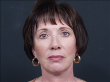 Facelift Before and After Photos by John Corey, MD; Scottsdale, AZ ...