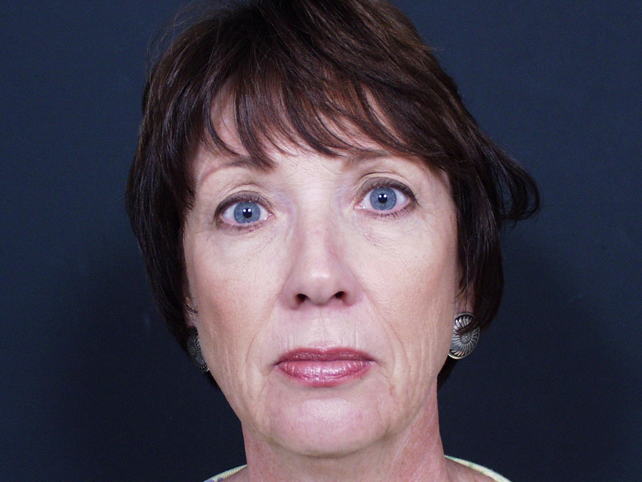 Facelift Before and After Photos by John Corey, MD; Scottsdale, AZ ...