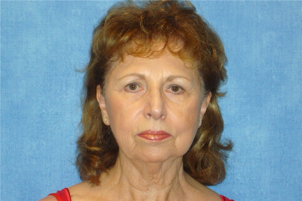 Facelift Before and After Photos by George John Alexander, MD, FACS ...