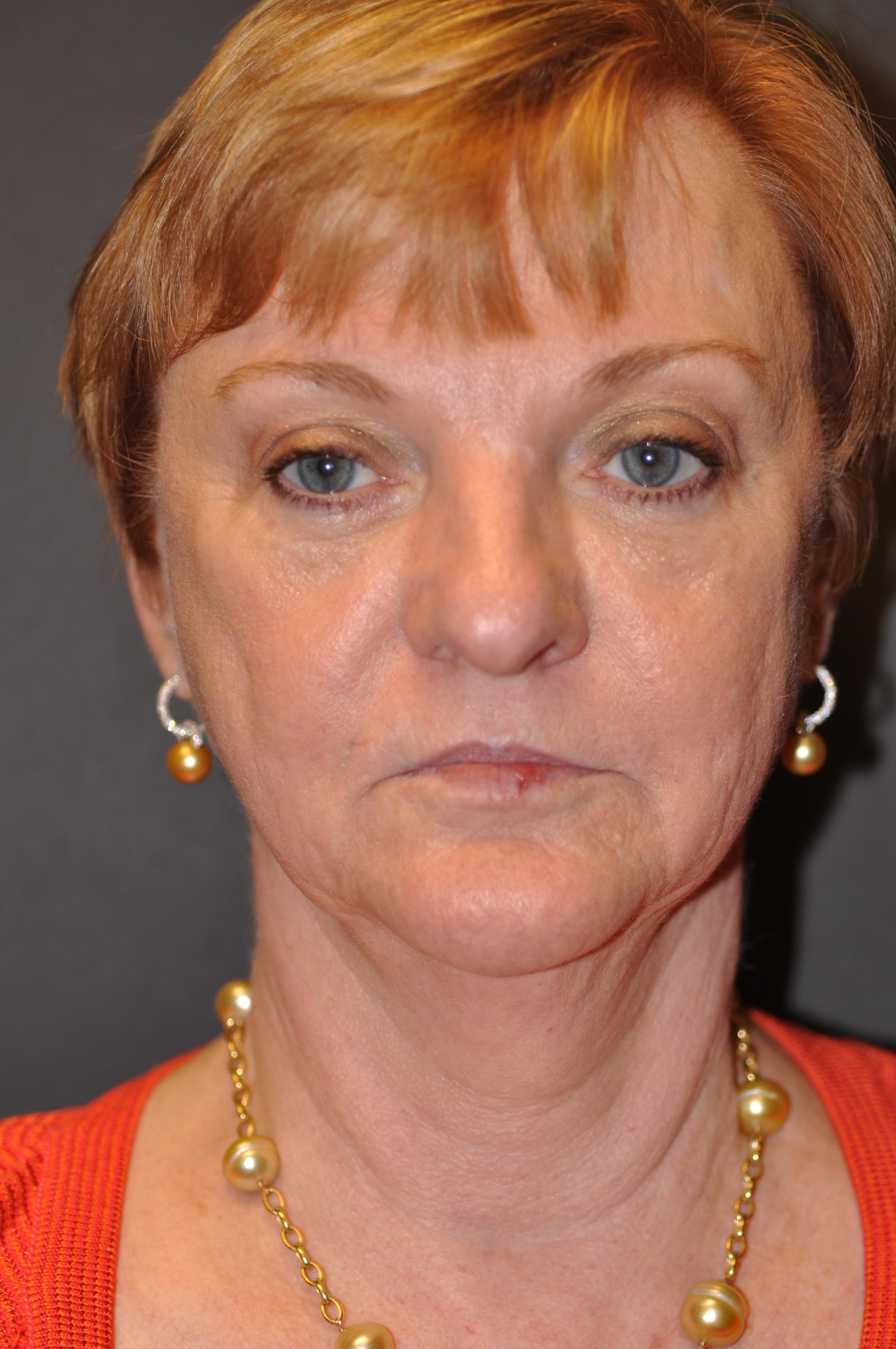 Facelift Before and After Photos by John Lindsey, MD; Metairie, LA ...