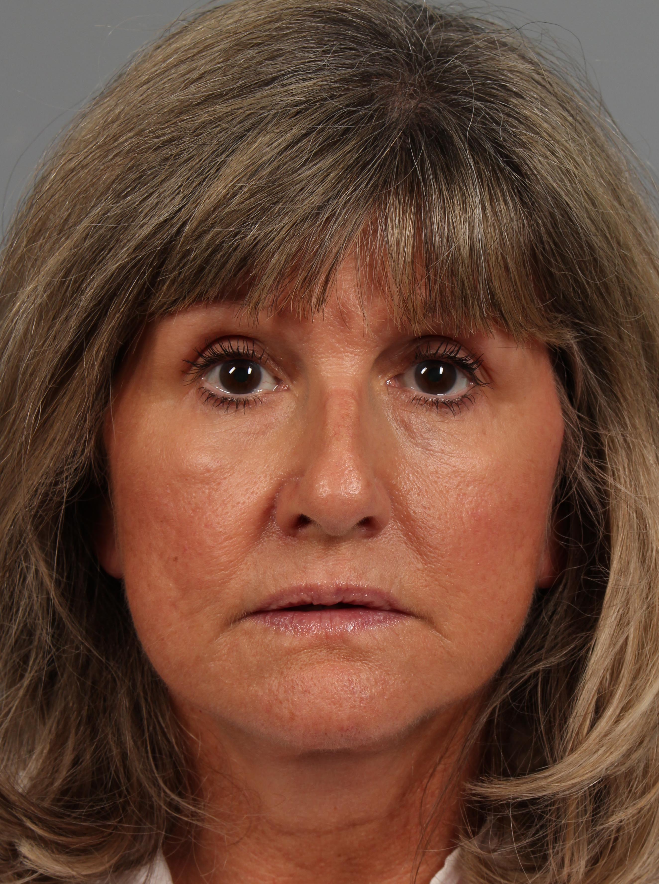 Facelift Before and After Photos by Gregory Mackay, MD; , - Case 29748 ...