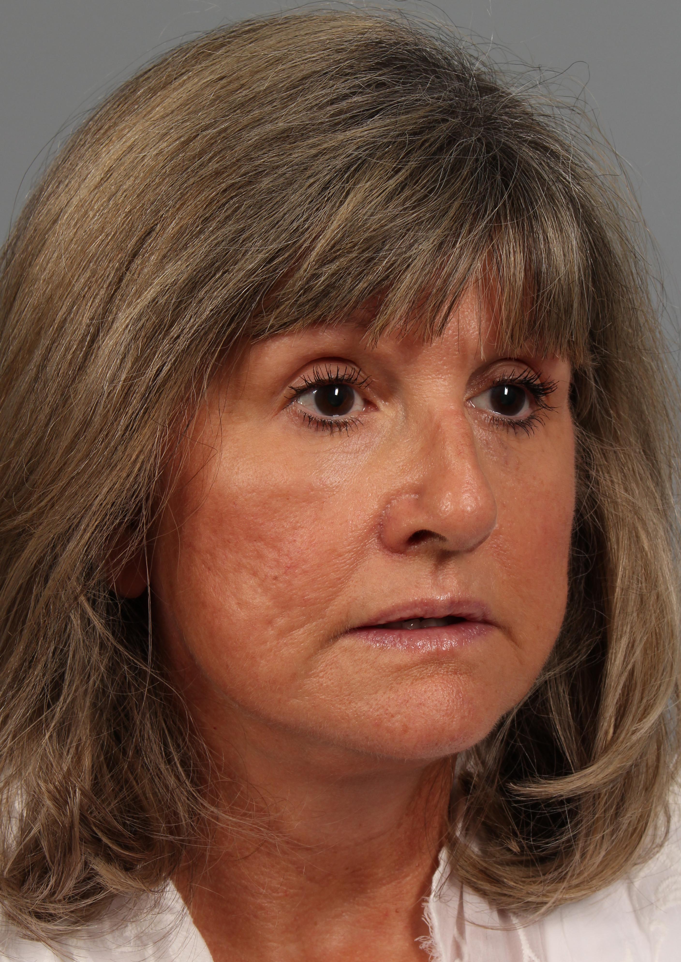 Facelift Before and After Photos by Gregory Mackay, MD; , - Case 29748 ...