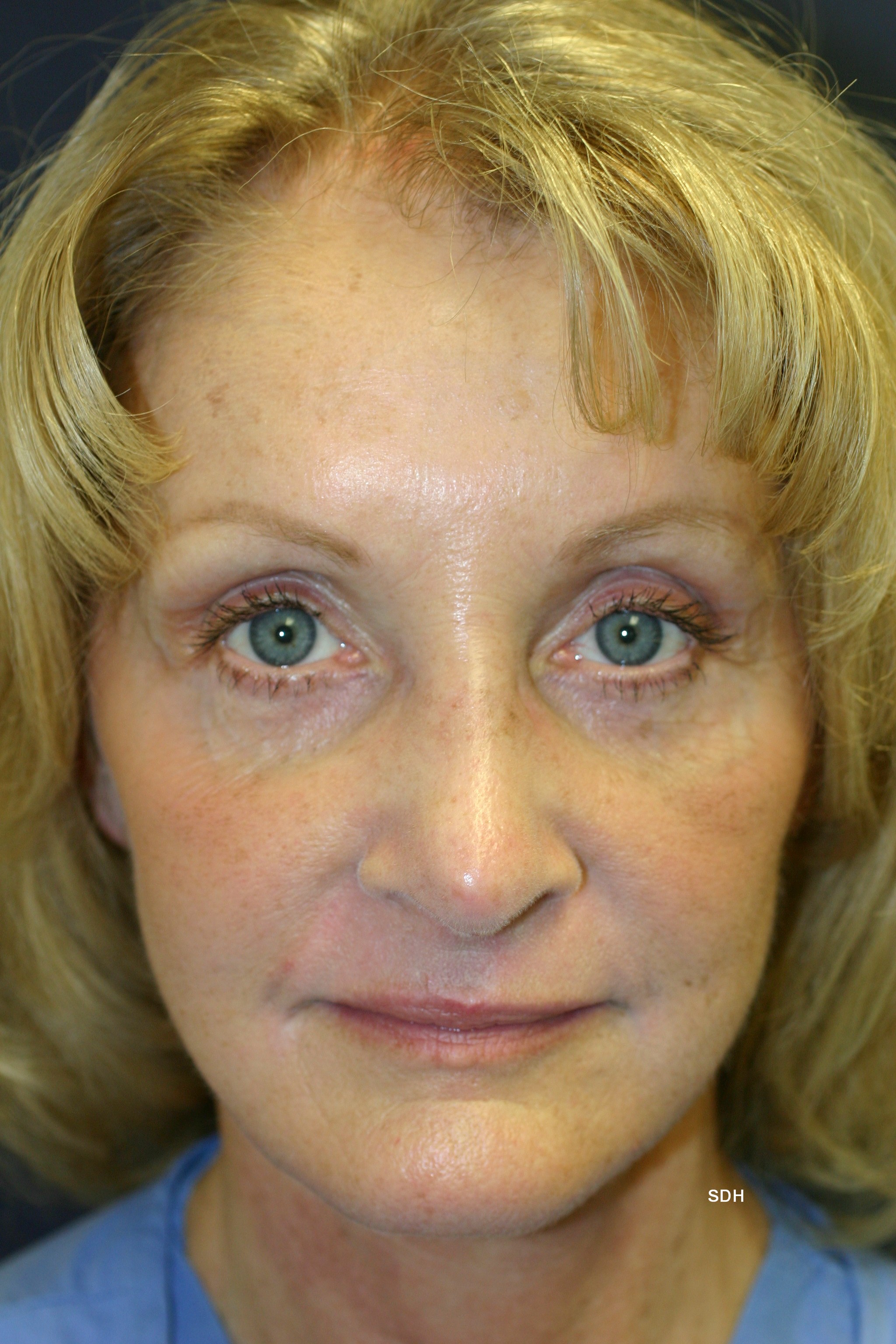 Facelift Before and After Photos by Scott Holley, MD; Portage, MI ...