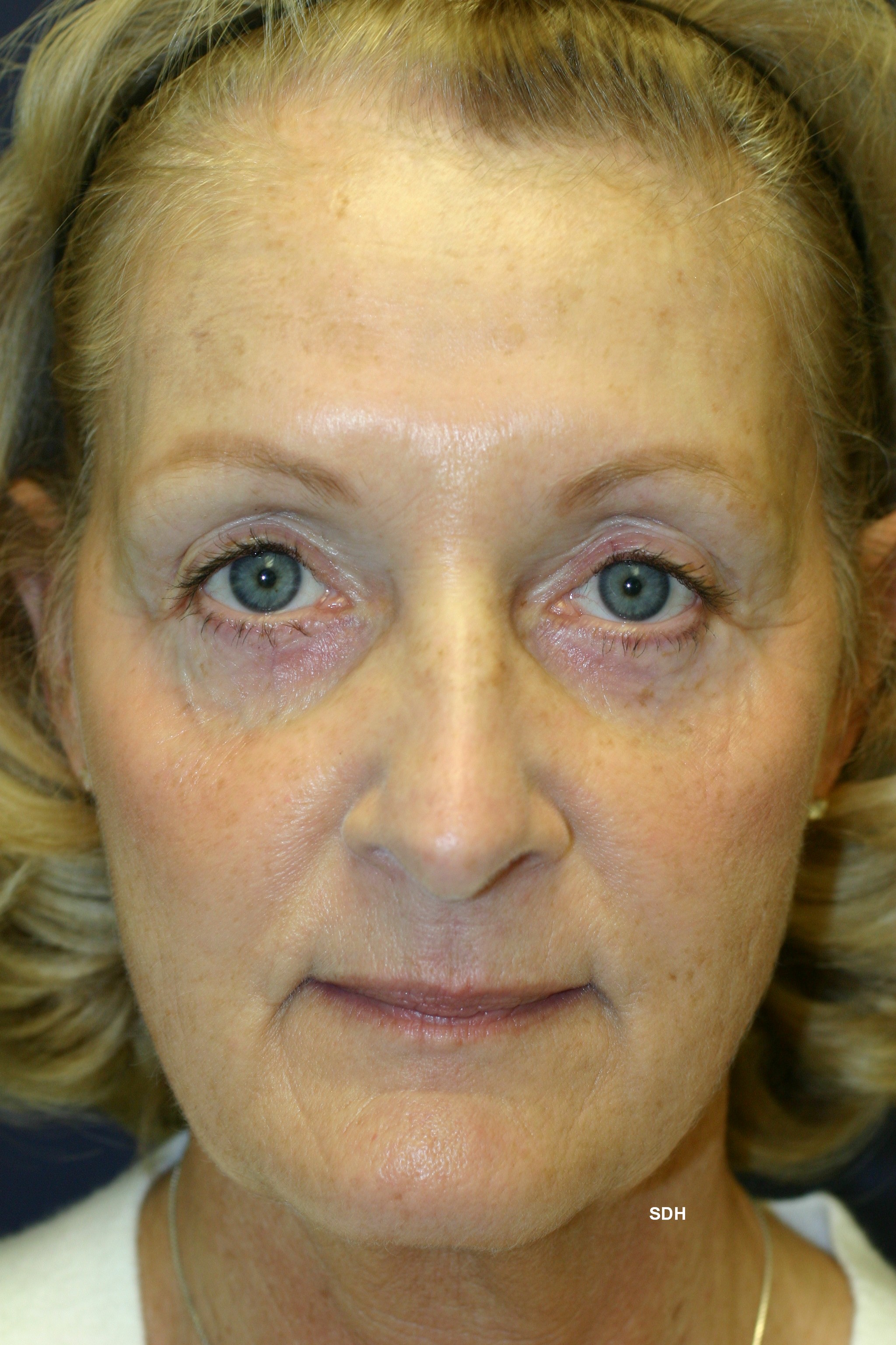Facelift Before and After Photos by Scott Holley, MD; Portage, MI ...