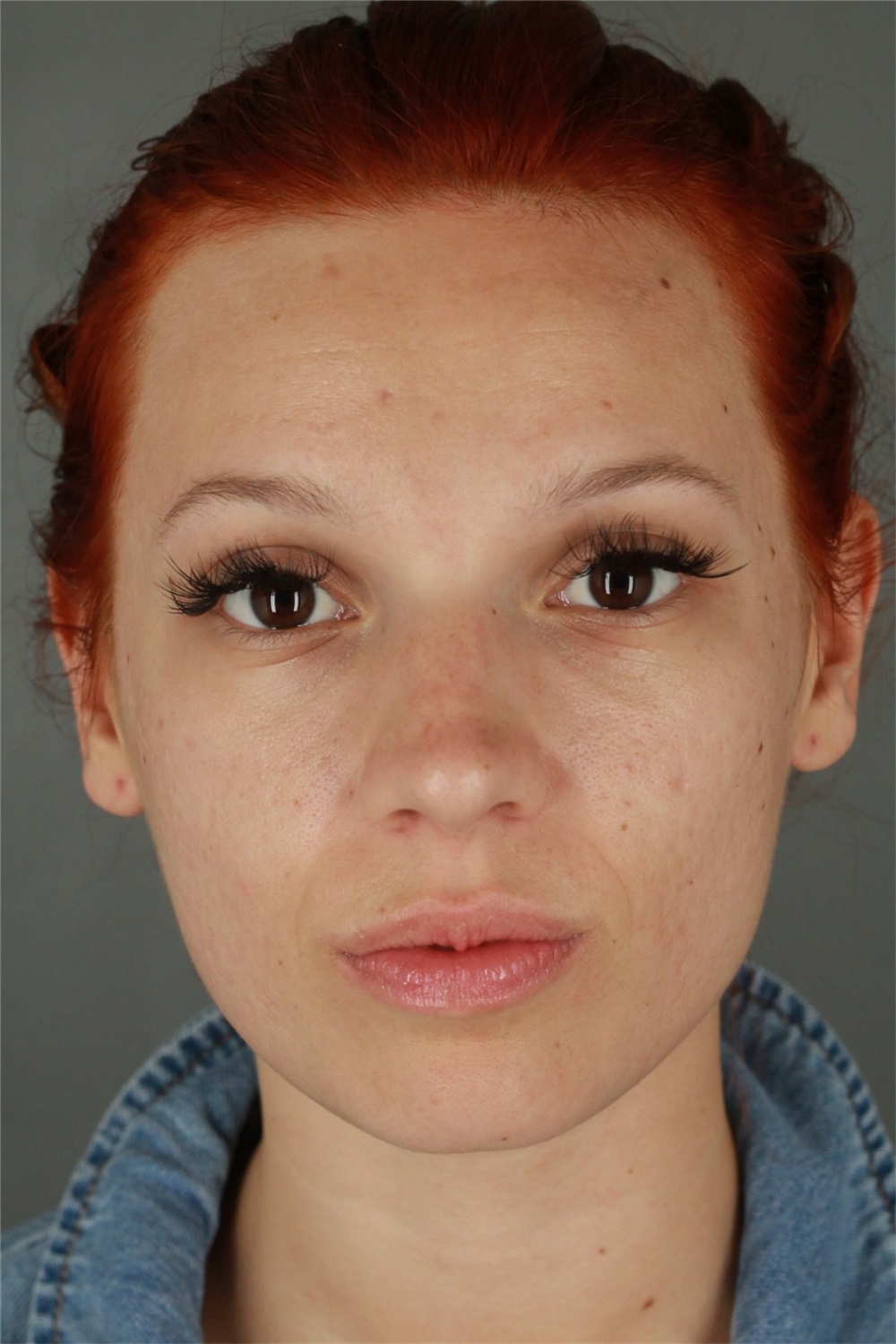 Rhinoplasty Before and After Photos by Patti Flint, MD; Scottsdale, AZ ...