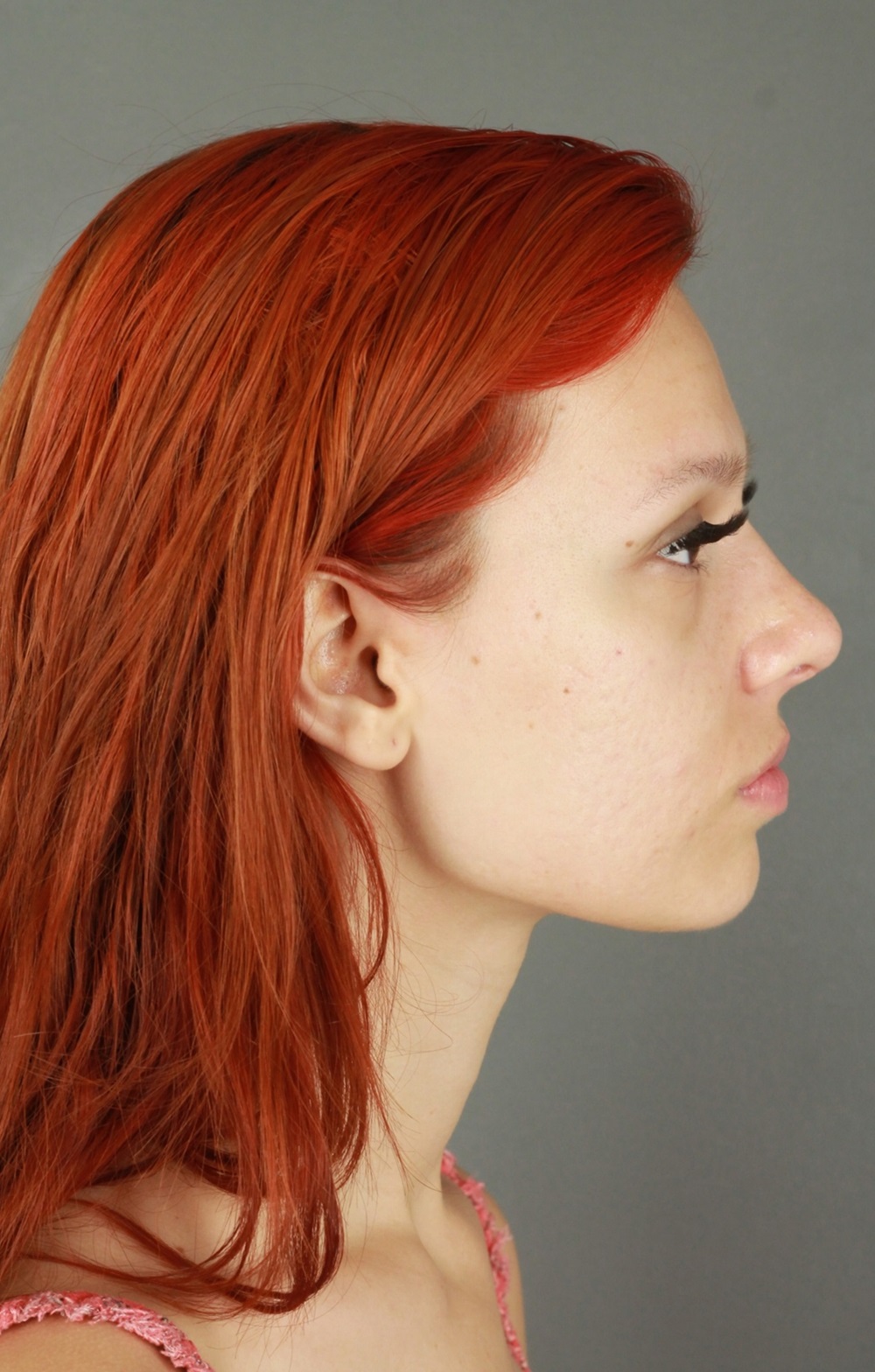 Rhinoplasty Before and After Photos by Patti Flint, MD; Scottsdale, AZ ...