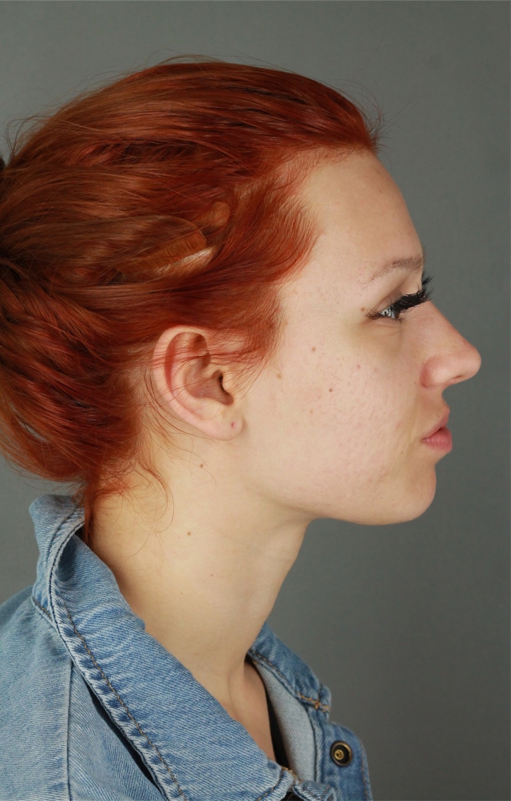 Rhinoplasty Before and After Photos by Patti Flint, MD; Scottsdale, AZ ...