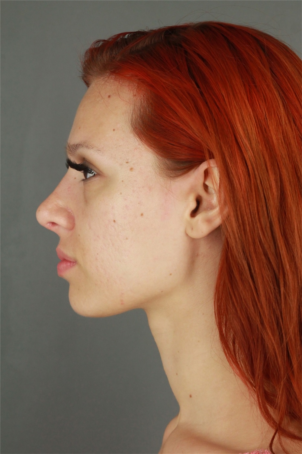 Rhinoplasty Before and After Photos by Patti Flint, MD; Scottsdale, AZ ...