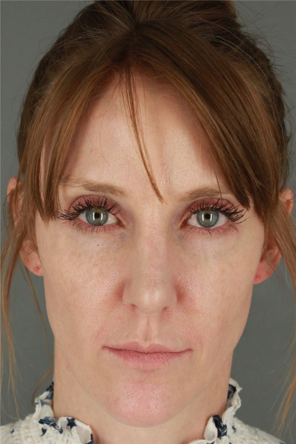 Rhinoplasty Before and After Photos by Patti Flint, MD; Scottsdale, AZ ...